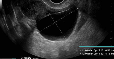 Simple Ovarian Cysts Iame