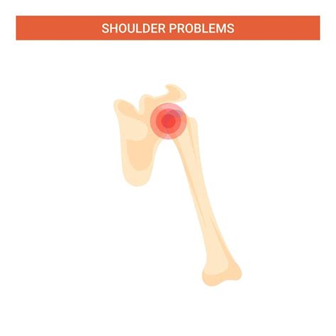 Premium Vector Human Shoulder Problems Vector Infographic