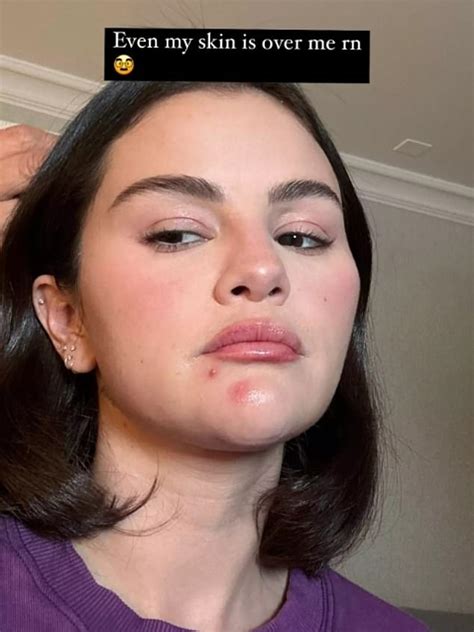 Selena Gomez Makes The Rare Move Of Showing Off Her Pimples As She Is Stressed From Emilia