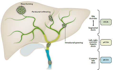 Figure 1 From Optimizing The Diagnosis And Biomarker Testing For Patients With Intrahepatic
