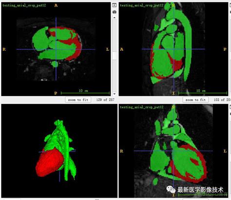 hvsmr2016心脏分割挑战赛 12697048的技术博客 51cto博客
