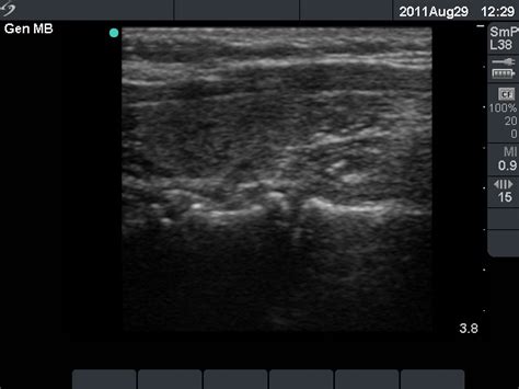 Parathyroid Lesions