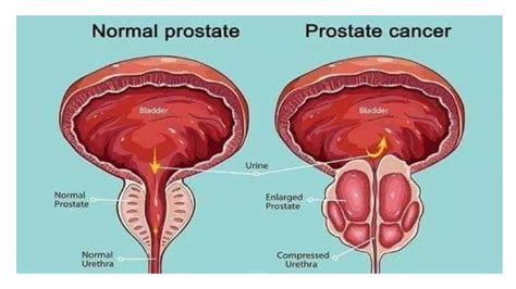 Diseases Of The Prostate Gland Paula Pptx
