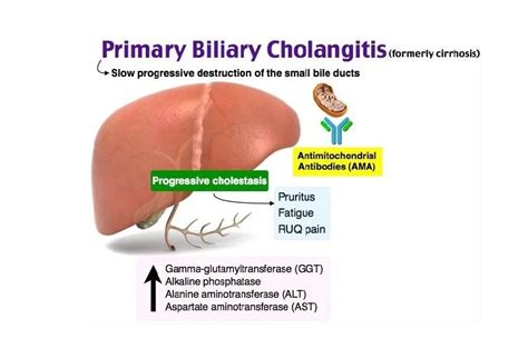 Primary Biliary Cirrhosis Symptoms Cause Diagnosis Treatment And Osteoporosis Science Online