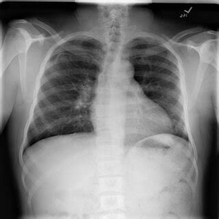 Pdf Lung Image Segmentation Custom U Net With Resnet Encoder Architecture