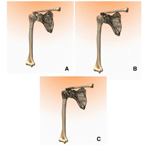 Soft Tissue Sarcoma Abutting The Bone A Is Approached Differently