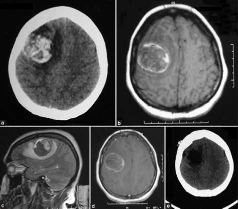 Supratentorial Primitive Neuroectodermal Tumor Presenting With