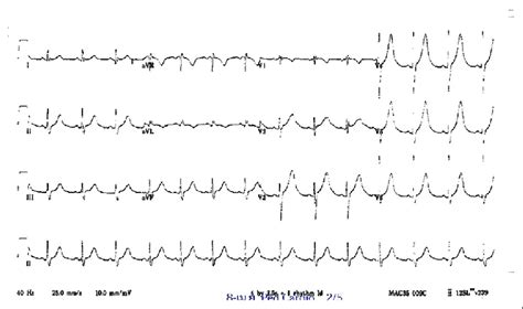 An Electrocardiogram Showed Qtc Prolongation Of 500 Ms Calculated By Download Scientific