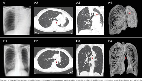 Figure 1 From Severe Acute Atelectasis Caused By Complete Obstruction
