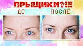 Заживляющая маска для лица от прыщей - YouTube