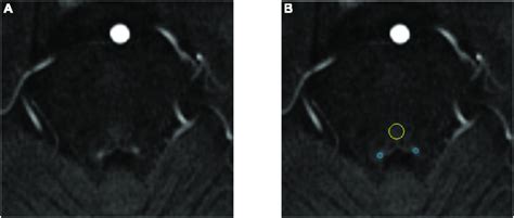 Schematic Diagram Of Locus Coeruleus Lc Signal And The Region Of