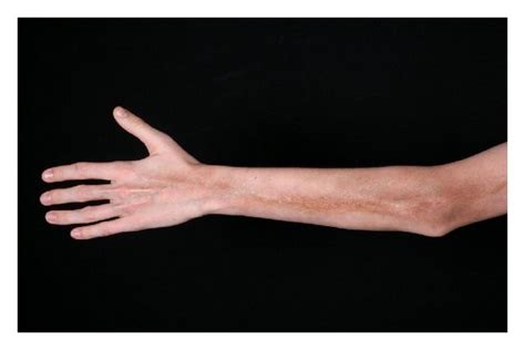 Linear Scleroderma Arm