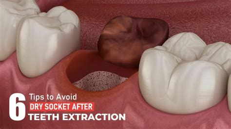 Tips To Avoid Dry Socket After Teeth Extraction Dental Blog