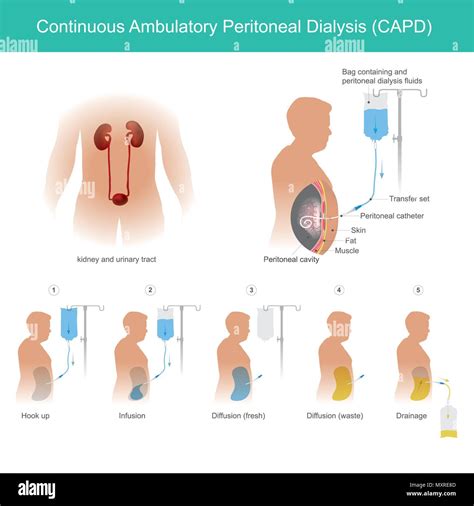 Ambulatory Peritoneal Dialysis Stock Vector Images Alamy