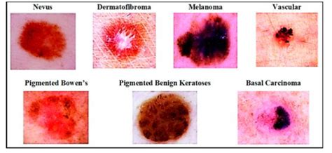 Isic 2019 Skin Lesion Examples Source Isic 2019 Download