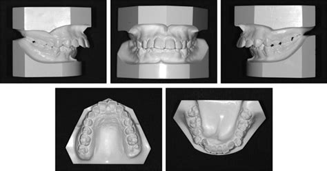 Two Phase Treatment Of Skeletal Class Ii Malocclusion With The