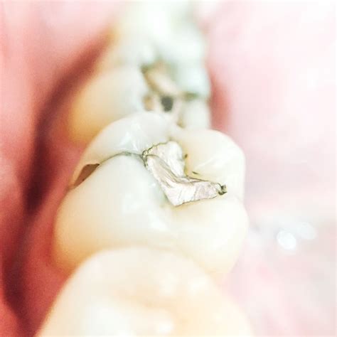 Amalgam Definition And Uses