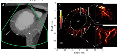 Transthoracic Super Resolution Ultrasound Localisation Microscopy Of Myocardial Vasculature In