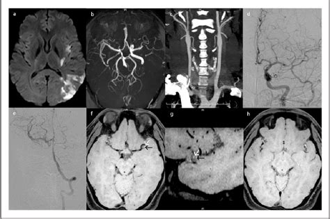 Figure 1 From M2 Segment Dissection Of Middle Cerebral Artery Diagnosed Using High Resolution