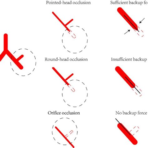 Model Figure Of Three Types Of Occlusions The Figure Demonstrated The Download Scientific