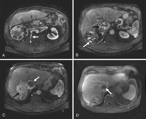 Surgical Reconstruction Of The Inferior Vena Cava And Iliofemoral
