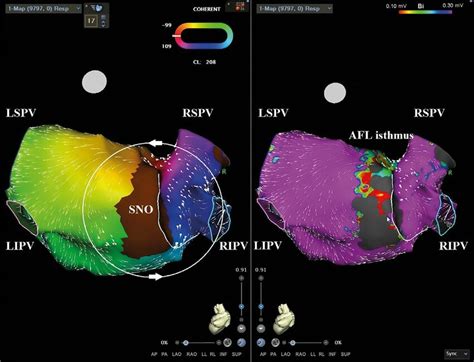 Electroanatomical Map Of The Left Atrium Of The Heart A Activation Download Scientific