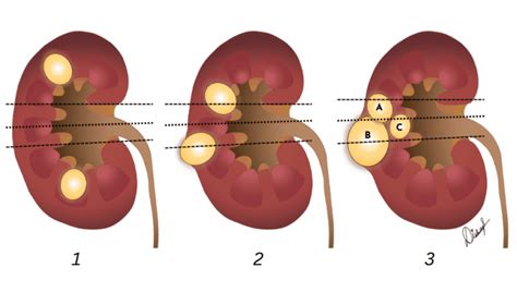 Renal Nephrometry Score Calculator Radiogyan
