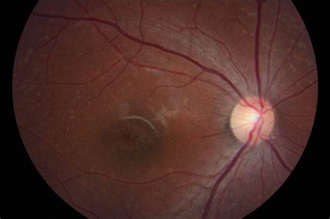 Ophthalmology Dx Central Retinal Atrophy In A Young Patient Ophthalmology Advisor