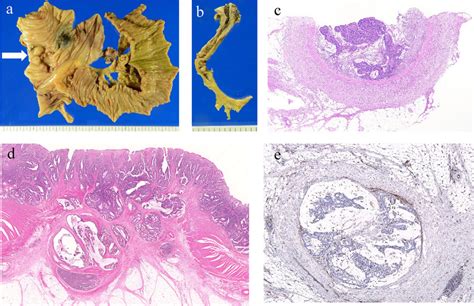 Pathological Findings Of The Resected Specimen A Macroscopic