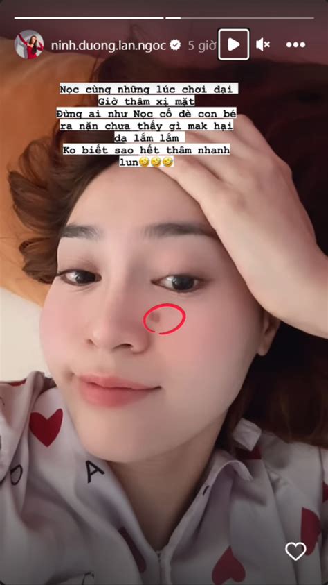 Ninh Dương Lan Ngọc gặp sự cố trên gương mặt khiến dân mạng lo lắng Saostar vn