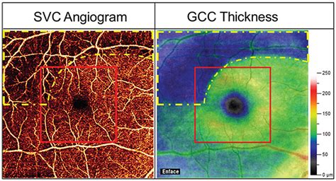 Managing Glaucoma With Oct Angiography