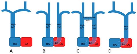 Persistent Left Superior Vena Cava With Absent Right Superior Vena Cava