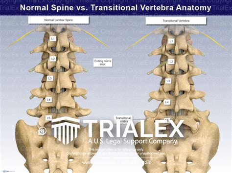 Normal Spine Vs Transitional Vertebra Anatomy Trialquest Inc