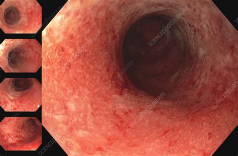 Colon In Ulcerative Colitis Endoscope Views Stock Image C060 9304