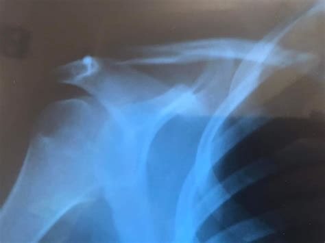Acromion Fracture R Radiology