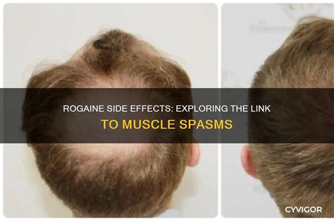 Rogaine Side Effects Exploring The Link To Muscle Spasms Cyvigor