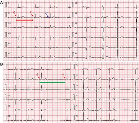Twelve Lead Synchronous Ecg Shows Sinus Node Conduction Abnormalities Download Scientific