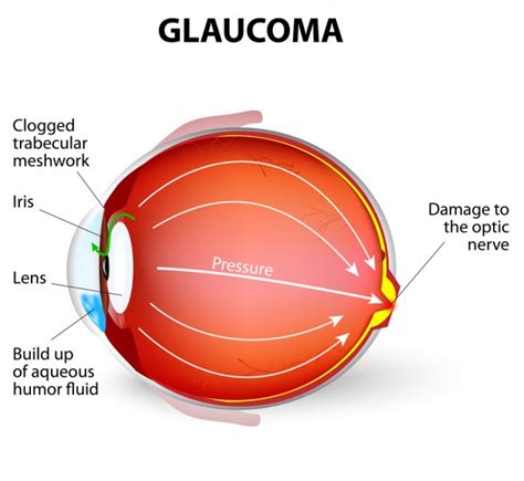 Glaucoma Diagram Discovery Eye Foundation