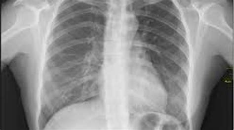 X Ray Discovery Day News Latest X Ray Discovery Day News Breaking X Ray Discovery Day News X