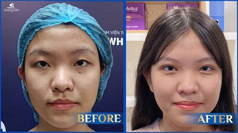 Cắt mí bao lâu thì đẹp tự nhiên giai đoạn hồi phục sau cắt mí mắt