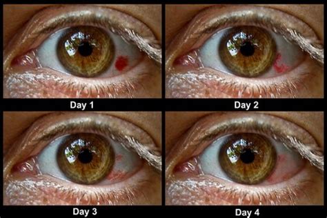 What Causes Broken Or Burst Blood Vessels In The Eyes Healdove
