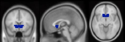 Ventral Striatum Vs Roi Mask Drawn Using An Average Brain In The Wfu