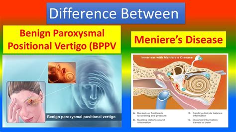 Benign Positional Vertigo Diagnosis Diagnosis And Treatment Of Bppv