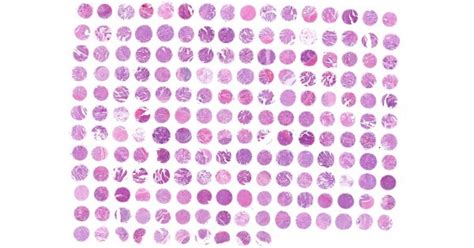 Co1861 Colon Cancer With Colon Tisue Array Including Pathology Grade Tnm And Clinical Stage