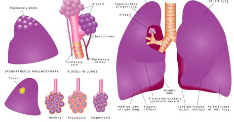 Spontaneous Pneumothorax Things To… Counseling Therapy