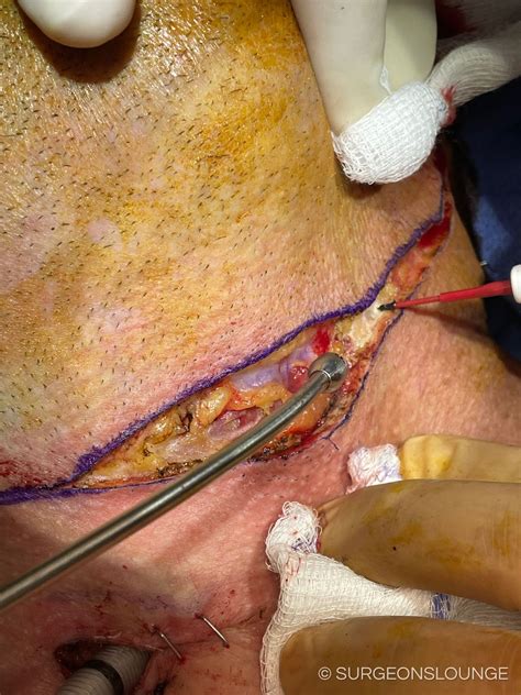Neck Dissection Level I Iv