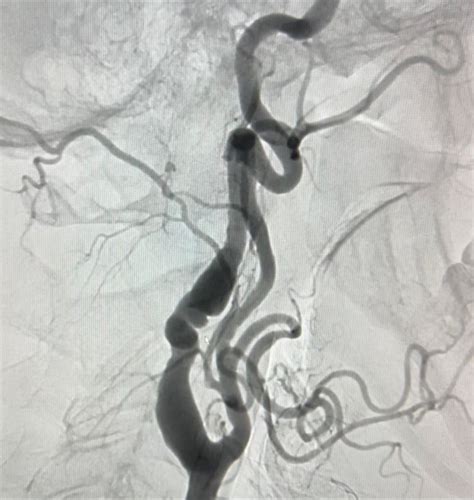 Symptomatic Internal Carotid Artery Dissection With Stenosis And Ectasia Intravascular