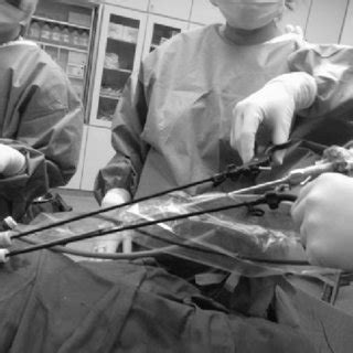 Pdf Single Incision Laparoscopic Surgery Excision Of Cornual Ectopic
