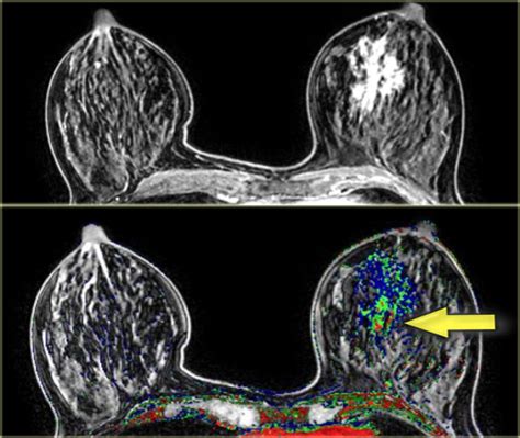The Radiology Assistant Breast Mri