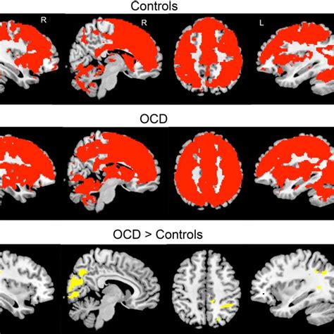 Activity In Obsessive Compulsive Disorder Ocd Patients And Controls